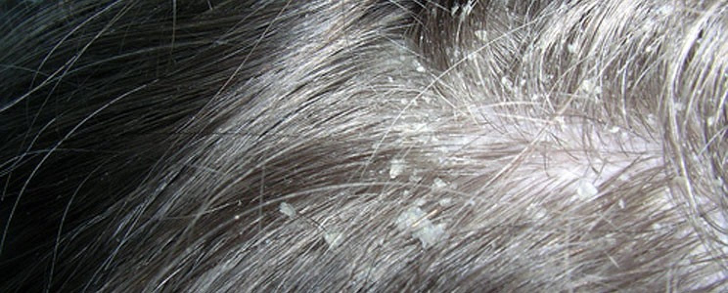 Caspa y Procesos Descamativos :: Simone-medicocosmetica